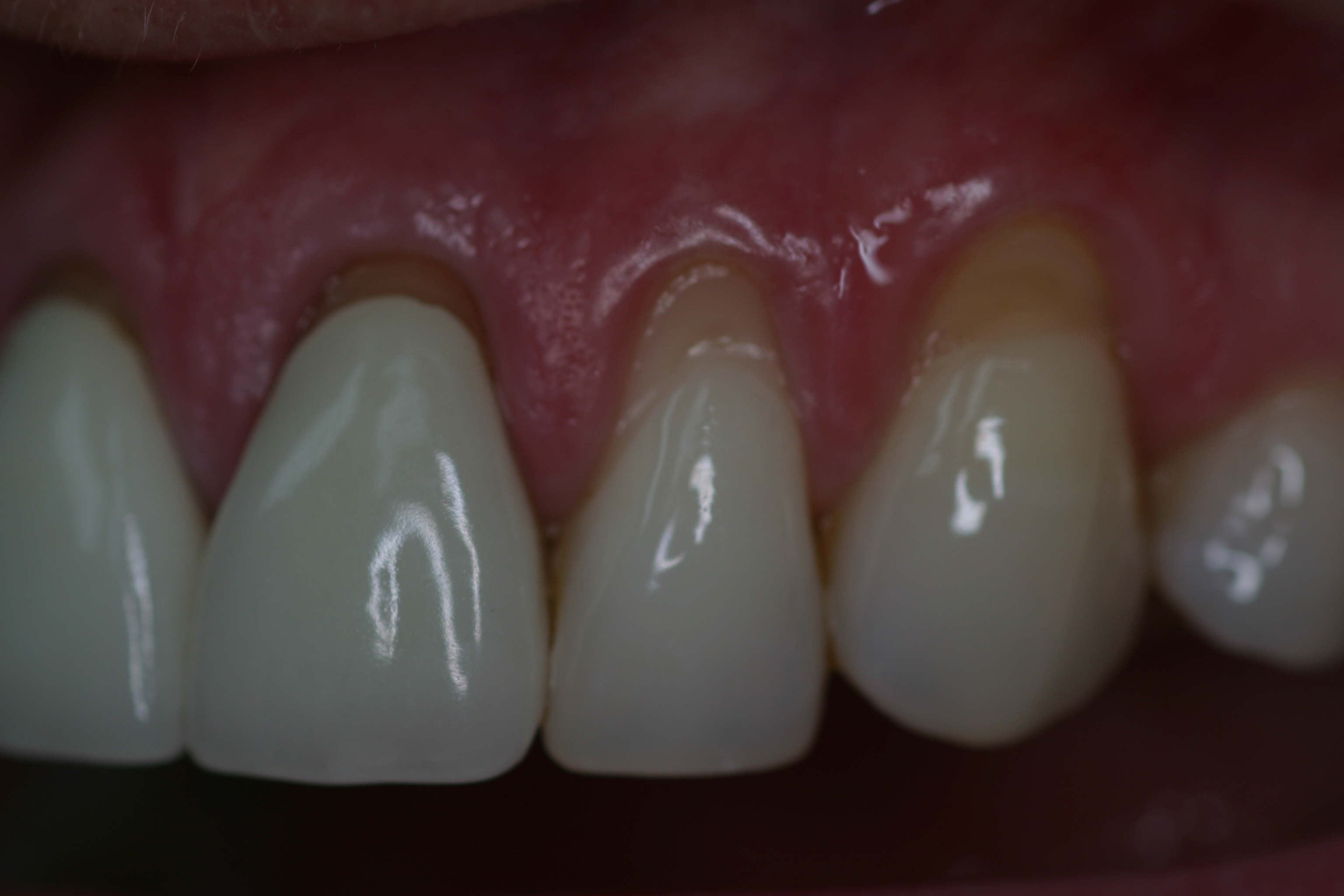 Cosmetic Dentistry Palm Desert CA | Cosmetic Periodontal Procedures